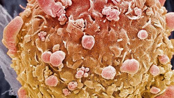 Skin cancer cell. Coloured scanning electron micrograph (SEM) - Stock ...