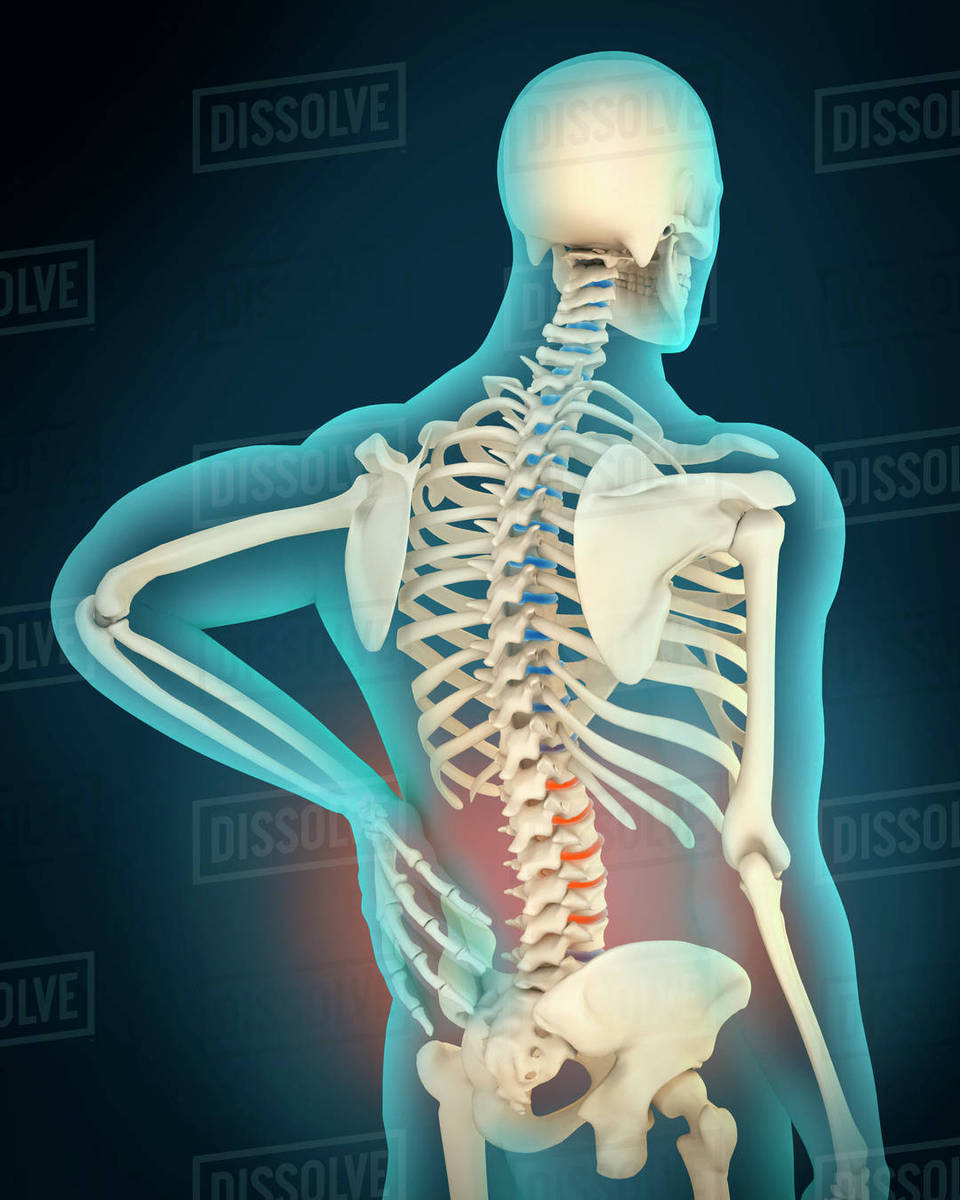 Medical illustration showing inflammation and pain in human back area ...