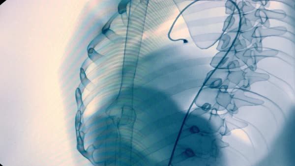 Black and white image of angiography of blood vessels in the human body ...