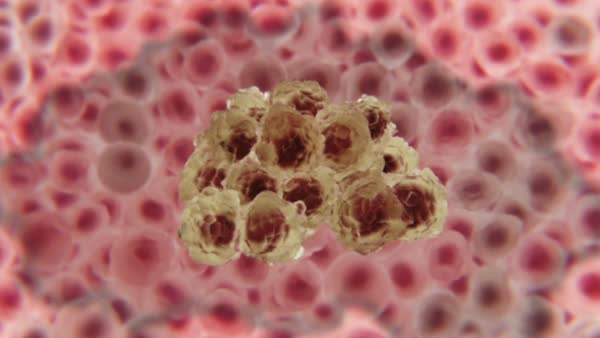 Animation showing radiation therapy successfully destroying cancer ...