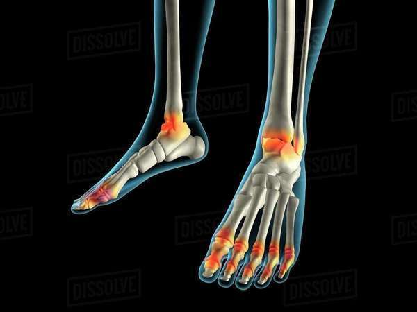 X-ray view of inflamed foot bones - Stock Photo - Dissolve