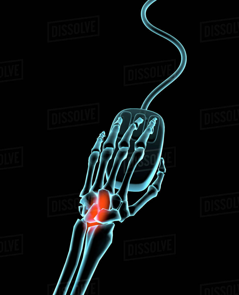 Skeleton of the human hand using a computer mouse showing carpal tunnel ...