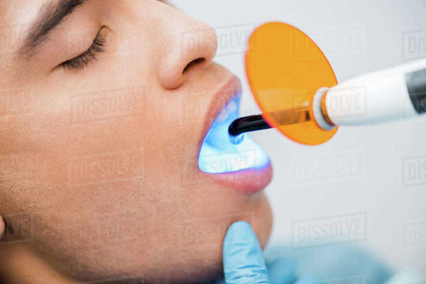 Close up of handsome african american man during bleaching procedure ...