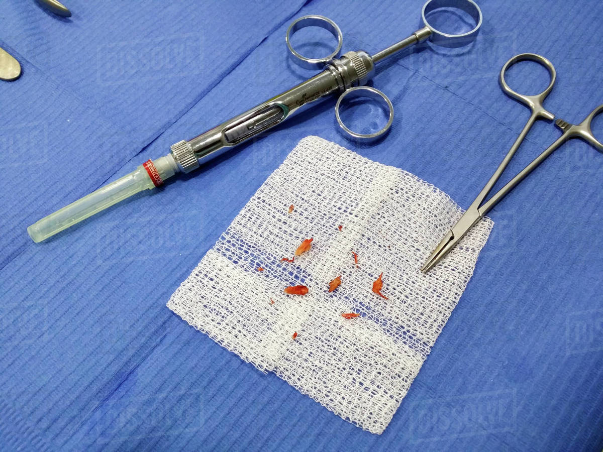 From above of bloody pieces of fingernails on gauze and surgical ...