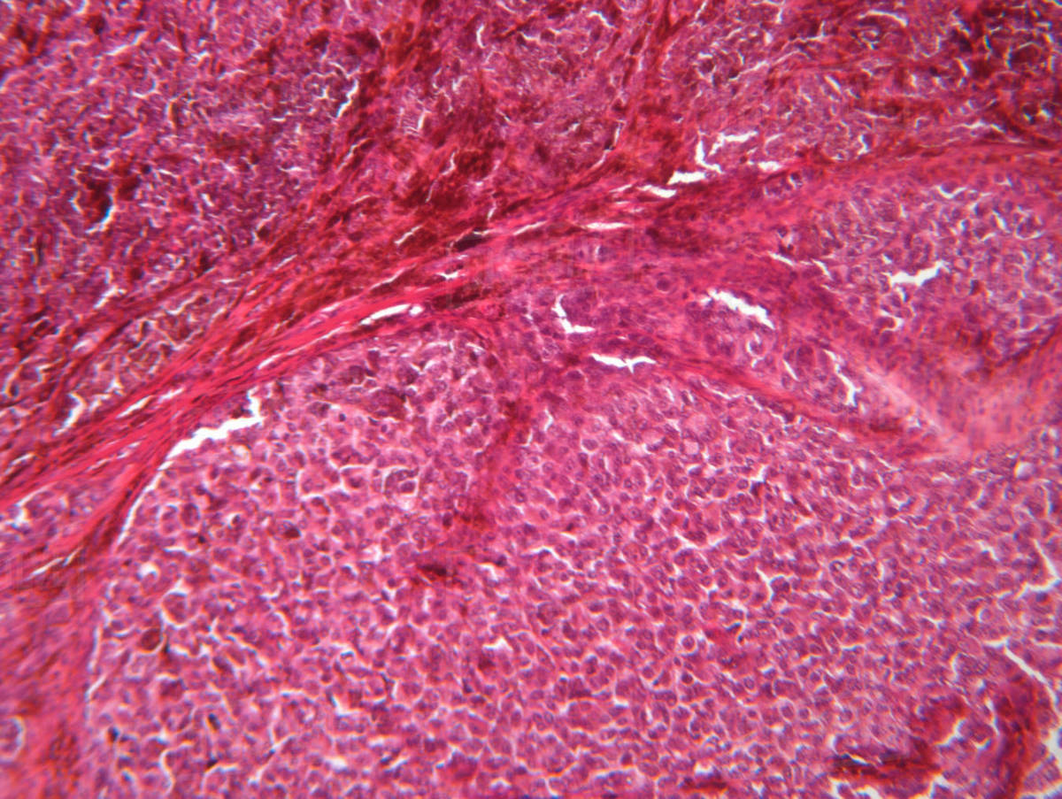 Microscope view of malignant melanoma - Royalty-free Stock Photo | Dissolve