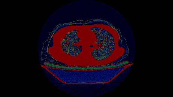 Miliary tuberculosis, CT scan - Stock Video Footage - Dissolve