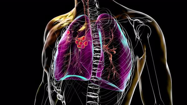 Primary lung tuberculosis, animation - 4K Royalty-free Stock Video ...