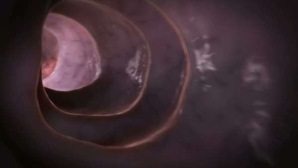 Animation of the inside of the large intestine showing faecal impaction ...