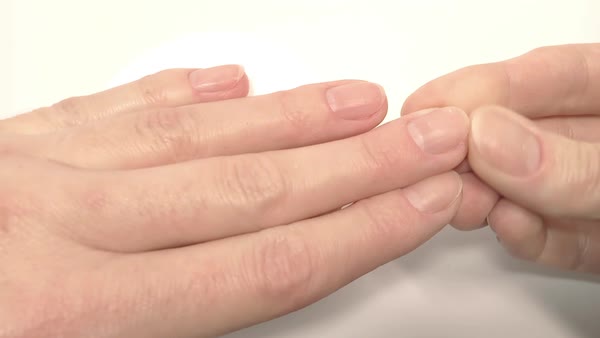 White spots on the fingernails, symptoms of iron deficiency anemia ...