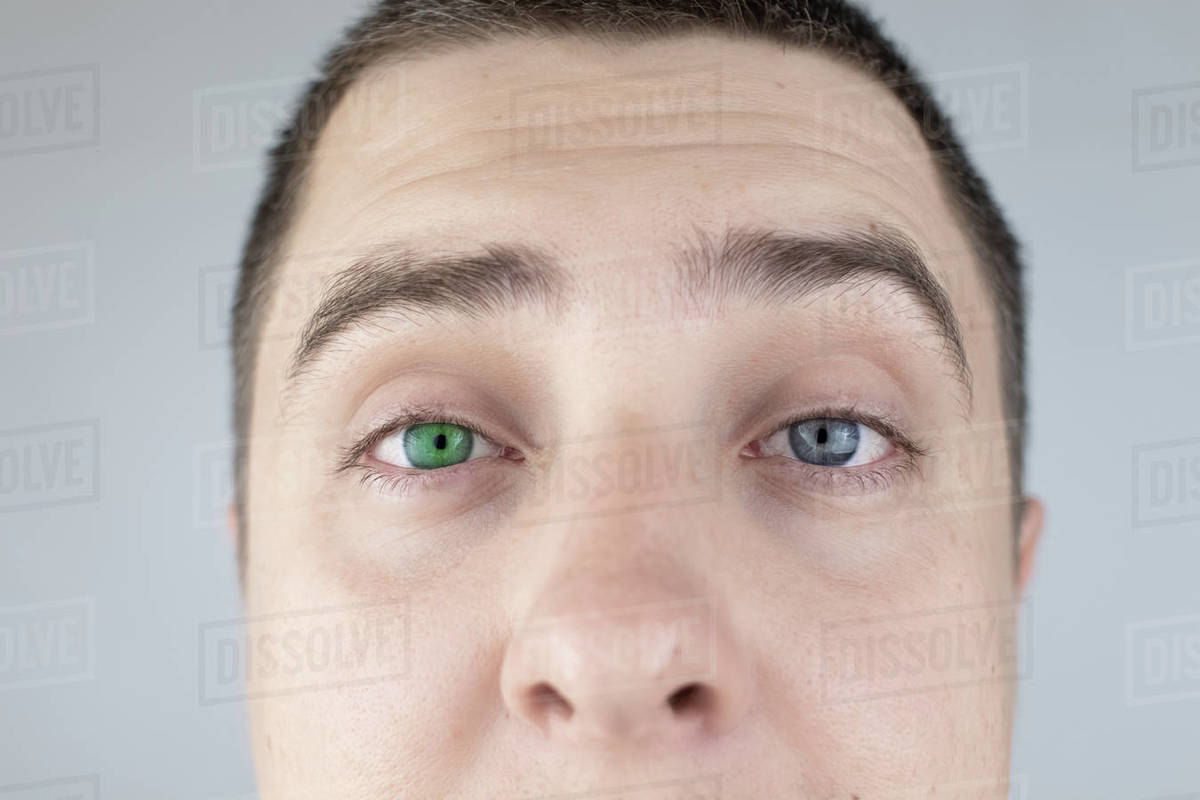 A man with different color eyes looks into the frame. The right eye is ...