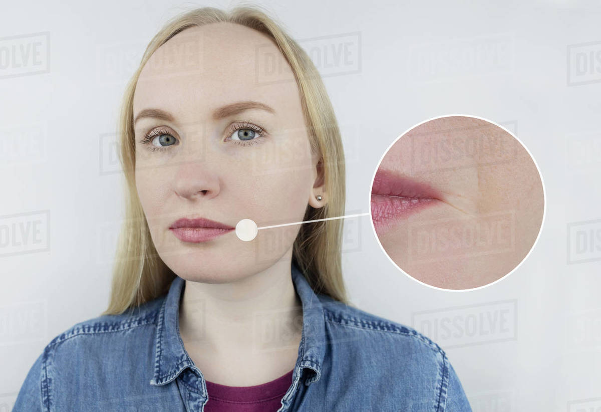 Mimic wrinkles. Rejuvenation. Lines remaining on problem areas of skin ...