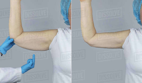 Before and after. Brachioplasty. Plastic arms, dangling skin at the ...