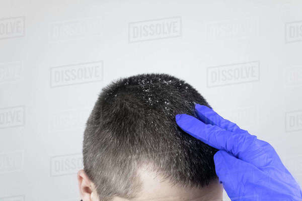 Dandruff on a man's shoulder. Side view of a man who has more dandruff ...
