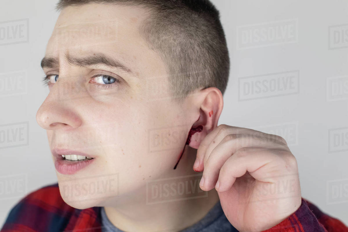 A man whose ear is bleeding. Vascular rupture, damage to the tympanic ...