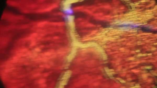 Blood Clots Under Microscope. Red Blood Cells and Platelets. Real image ...