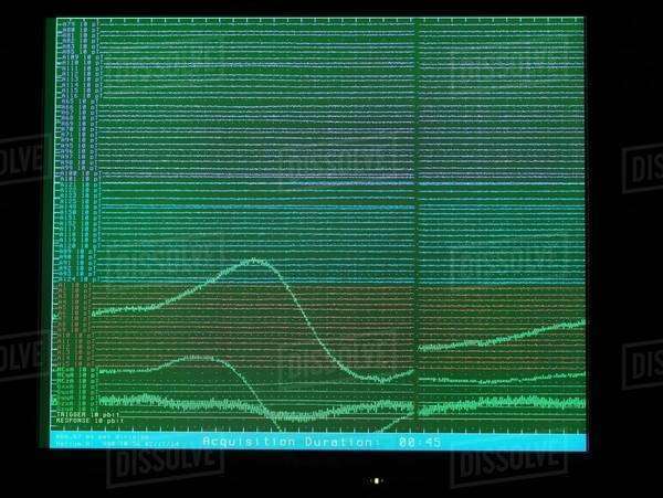 Screen showing magnetoencephalography (MEG) scan - Stock Photo - Dissolve