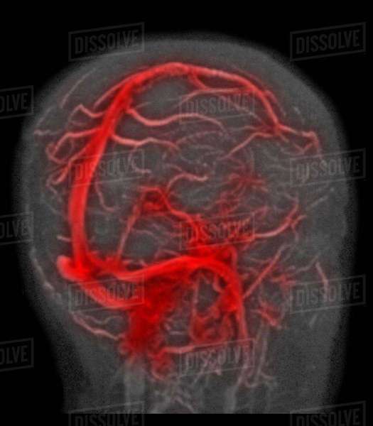 Normal brain MRI, magnetic resonance venography - Stock Photo - Dissolve