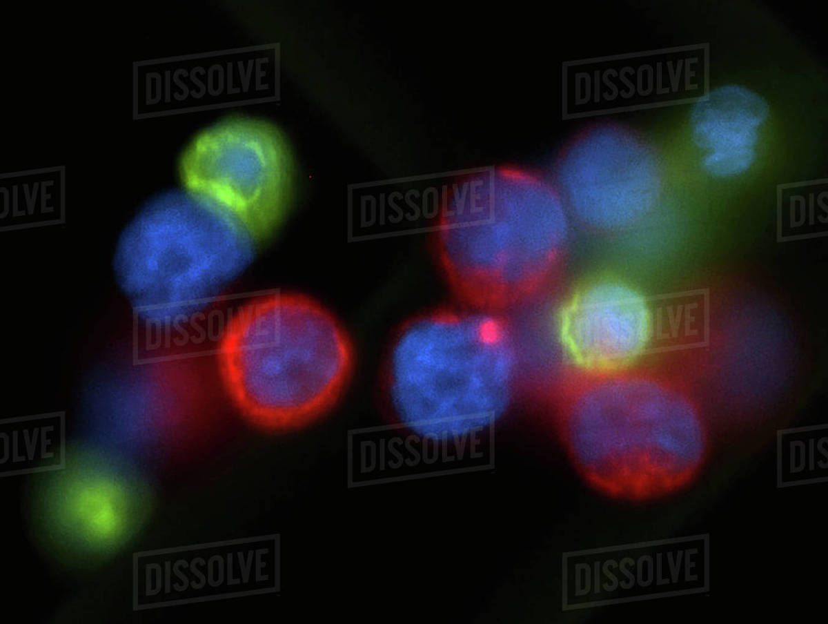 Microscopic image of circulating breast cancer cell cluster - Royalty ...