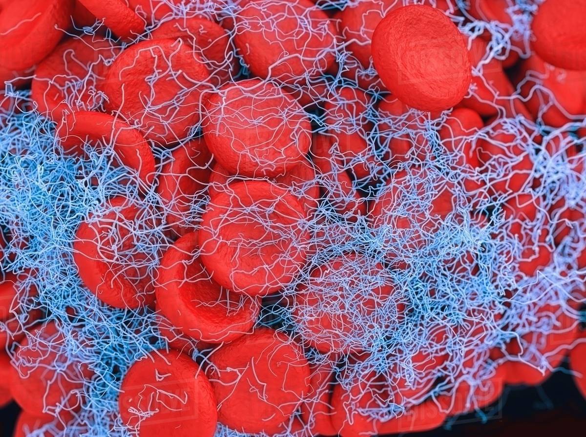 Illustration Of A Blood Clot Showing A Clump Of Red Blood Cells Illustration Of A Blood Clot Showing A Clump Of Red Blood Cells